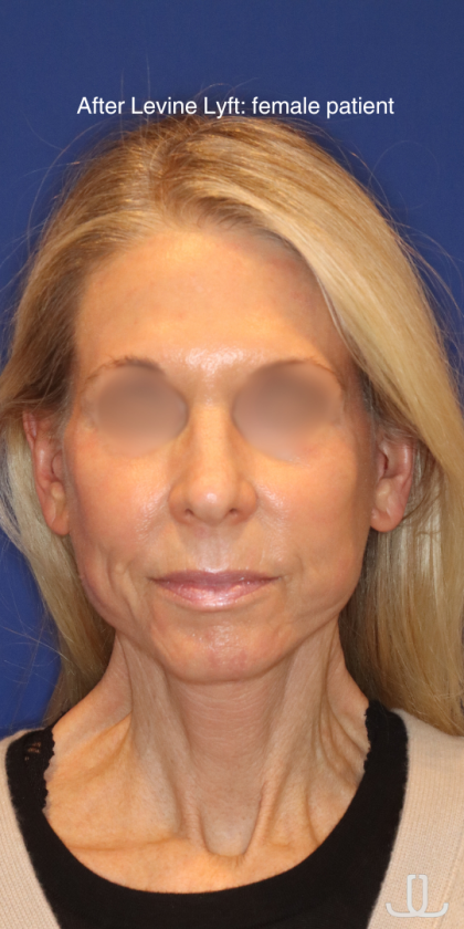 Patient #15101 Facelift / Neck Lift Before and After Photos New York ...