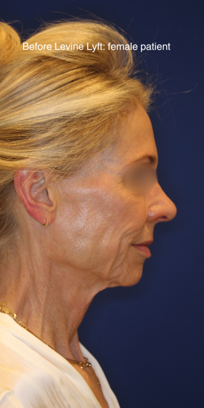 Patient #15101 Facelift / Neck Lift Before and After Photos New York ...