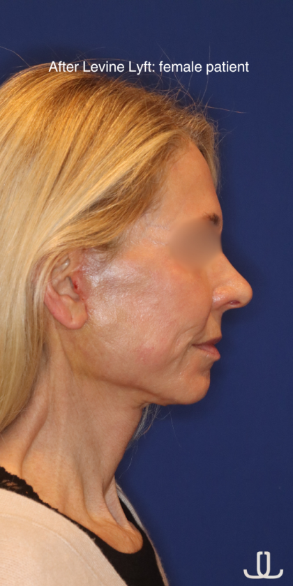 Patient #15101 Facelift / Neck Lift Before and After Photos New York ...
