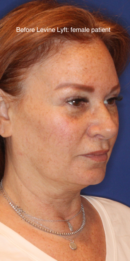 Patient #15102 Facelift / Neck Lift Before and After Photos New York ...