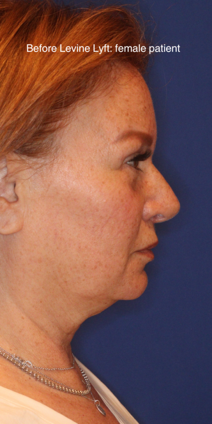 Patient #15102 Facelift / Neck Lift Before and After Photos New York ...