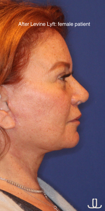 Patient #15102 Facelift / Neck Lift Before and After Photos New York ...