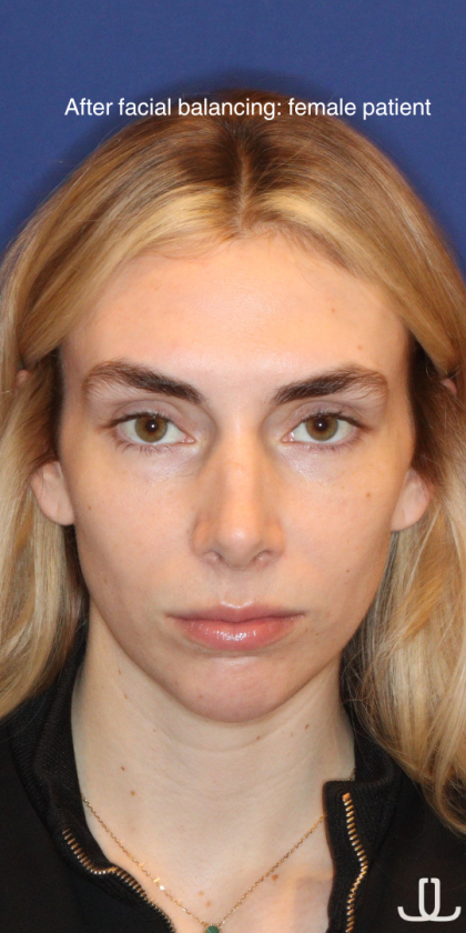 Best Facial Balancing NYC | Dr. Jennifer Levine