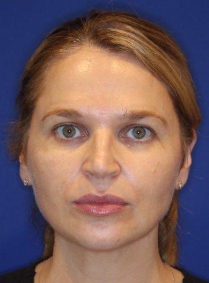 Patient #13838 Lip Filler Before and After Photos New York, NY ...