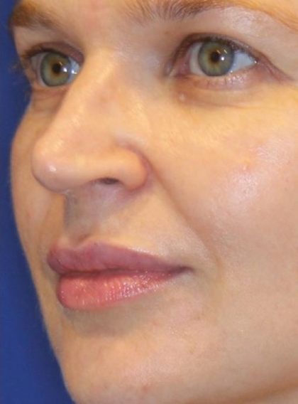 Patient #13838 Lip Filler Before and After Photos New York, NY ...