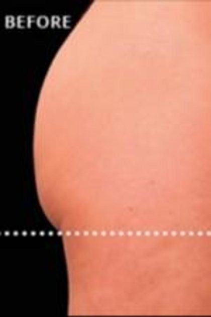 Best Non-Surgical Butt Lift NYC | Dr. Jennifer Levine
