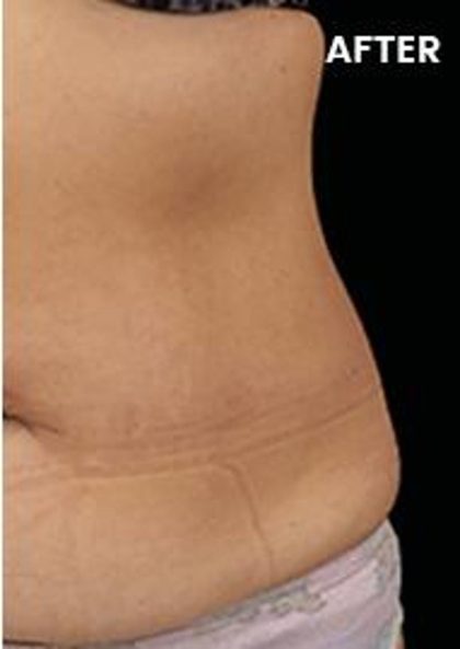 Patient #14218 CoolSculpting Elite Before and After Photos New York, NY ...