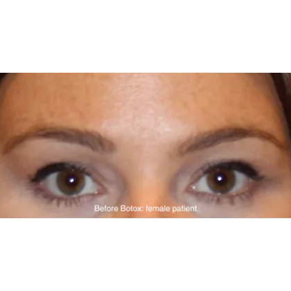 Patient #15133 Botox & Wrinkle Relaxers Before and After Photos New ...