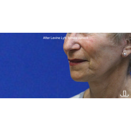 Patient #15095 Facelift / Neck Lift Before and After Photos New York ...