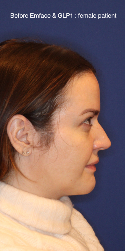 Patient #16194 Emface Before and After Photos New York, NY - Plastic ...