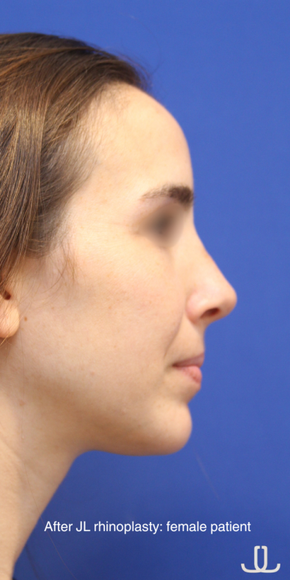 Patient #16199 Rhinoplasty Before and After Photos New York, NY ...