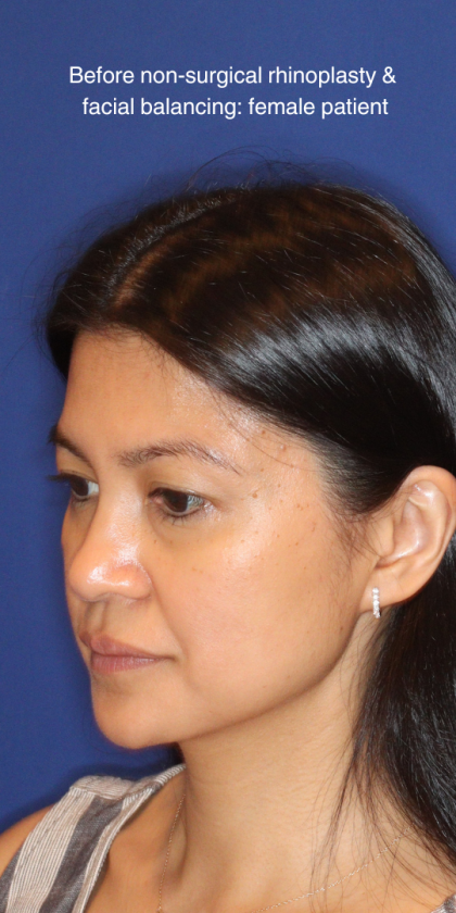 Patient #16198 JL Facial Balancing Before and After Photos New York, NY ...