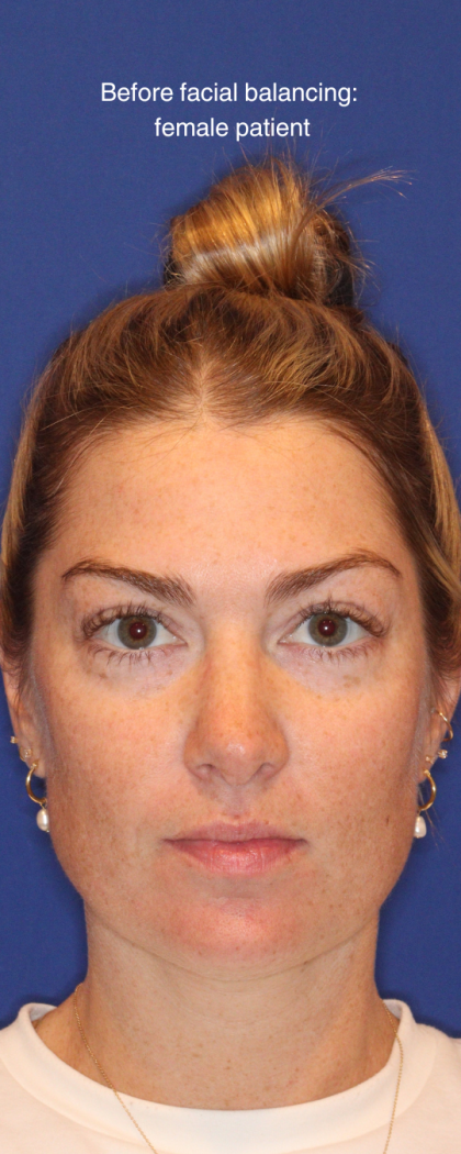 Patient #16750 JL Facial Balancing Before and After Photos New York, NY ...