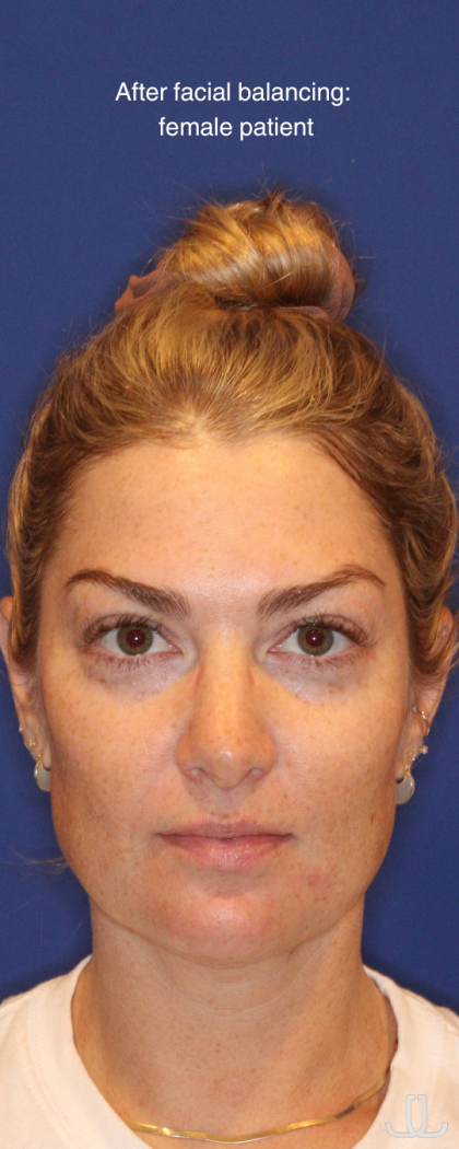 Best Facial Balancing NYC | Dr. Jennifer Levine