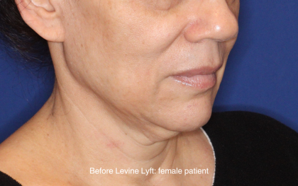 Patient #16746 Facelift / Neck Lift Before and After Photos New York ...