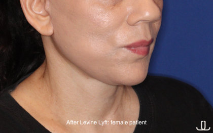 Patient #16746 Facelift / Neck Lift Before and After Photos New York ...