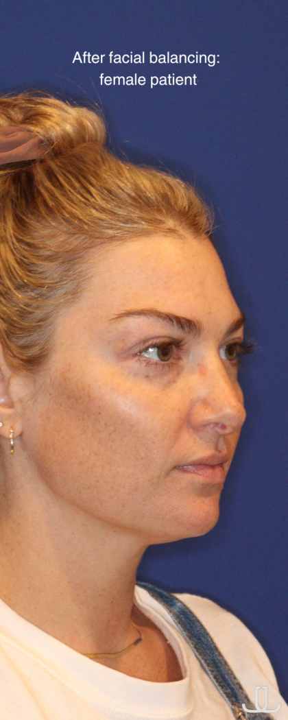 Patient #16750 JL Facial Balancing Before and After Photos New York, NY ...