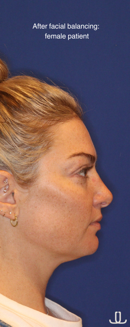 Patient #16750 JL Facial Balancing Before and After Photos New York, NY ...
