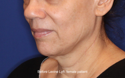 Patient #16746 Facelift / Neck Lift Before and After Photos New York ...